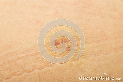 Bruise From Injection Stock Image | CartoonDealer.com #102289681