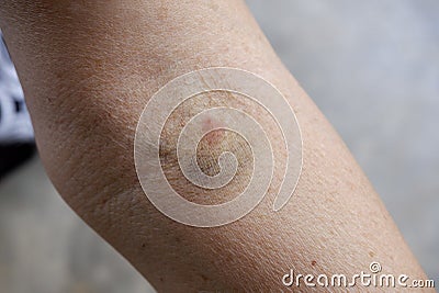 Bruising From Using A Needle To Draw Blood In The Arm Royalty-Free ...