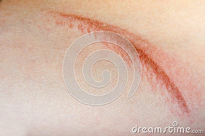 Burned Skin Scar Royalty Free Stock Photos - Image: 24660028