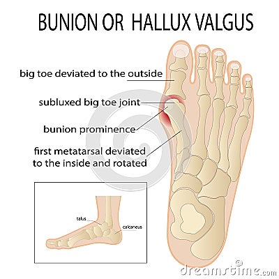 Bursitis On The Sides Of The Foot. The Bone And Skin On The Sides Of ...