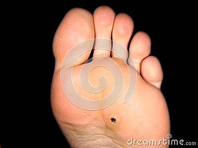 Callus Under Foot Stock Photo - Image: 31547350