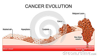 Cancer Evolution. Mutated Cell, Hyperplasia, Dysplasia, Malignant Tumor ...