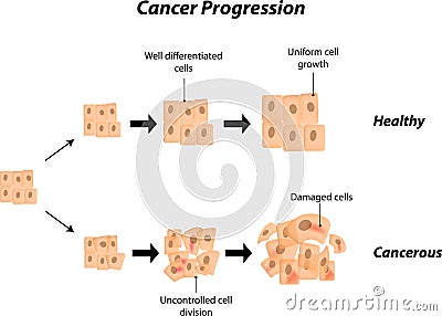 Cancer Progression Stock Vector - Image: 43334622