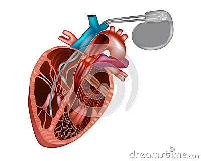 Cardiac Pacemaker Or Artificial Pacemaker. Vector Illustration ...