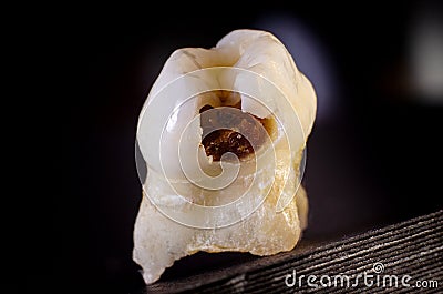 Caries On A Human Tooth On A Dark Background Royalty-Free Stock Image ...
