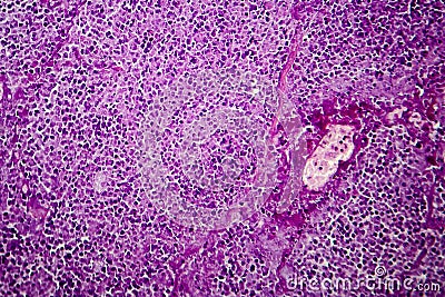 Caseation Of Human Tuberculosis Granuloma, Light Micrograph Stock ...
