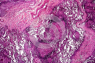 Caseous Pneumonia, Light Micrograph Royalty-Free Stock Photography ...
