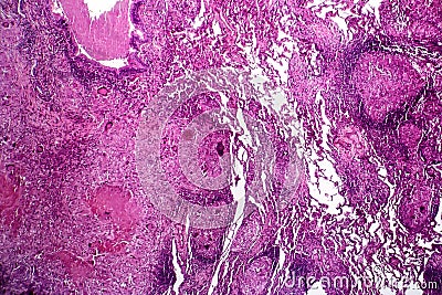 Caseous Pneumonia, Light Micrograph Stock Photography | CartoonDealer ...