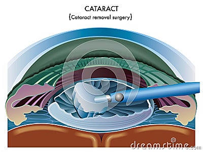Cataract Cartoon Vector | CartoonDealer.com #22343549
