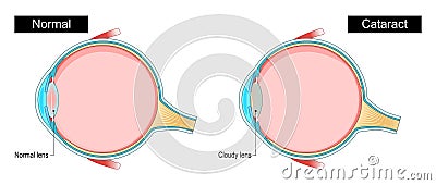 Cataract. Cross Section Of A Human Eye Cartoon Vector | CartoonDealer ...