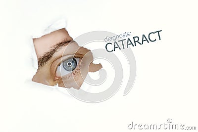 Cataract Disease Poster With Blue Eye On Left Royalty-Free Stock Image ...