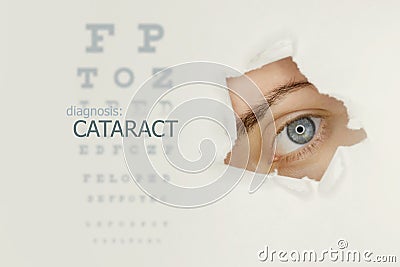 Cataract Disease Poster Wwith Eye Test Chart And Blue Eye On Right ...