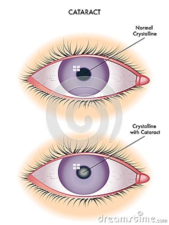 Cataract Cartoon Vector | CartoonDealer.com #37526547