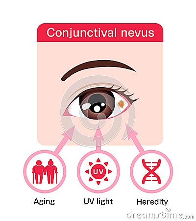 Causes Of Conjunctival Nevus Vector Illustration | CartoonDealer.com ...