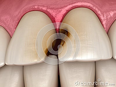 Central Incisor Teeth Damaged By Caries. Medically Accurate Tooth 3D ...