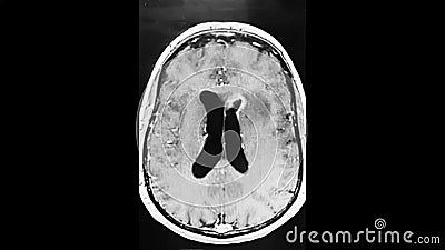 Cerebellum on CT Scan with Bird-like Appearance Stock Video - Video of ...