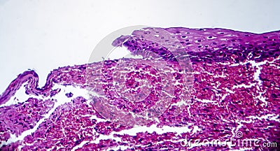 Cervical Ectropion, Light Micrograph Royalty-Free Stock Photo ...