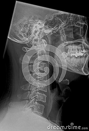 Cervical Spine Xray Side View Royalty Free Stock Photos - Image: 21747738