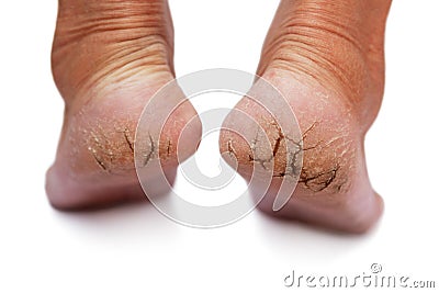 Chapped Heel Royalty-Free Stock Photo | CartoonDealer.com #25813977