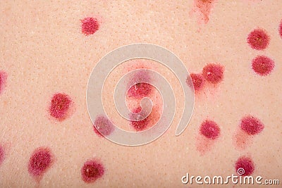 Chickenpox Rash On The Body Royalty-Free Stock Photography ...
