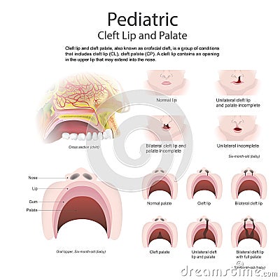 Cleft Lip And Cleft Palate. Vector Art, Illustration. | CartoonDealer ...