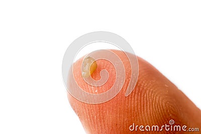 Closed Up Of Pimple Blackheads On A Finger Tip Stock Photo - Image ...