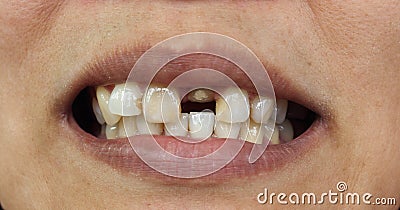 Closeup Of Bad Teeth Royalty Free Stock Images - Image: 18111309