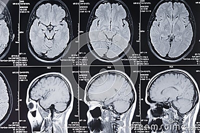 MRI Brain Scan or X-ray Neurology Human Head Skull Tomography Test ...