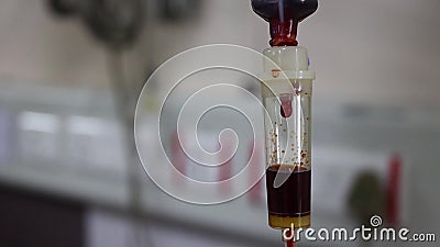 Closeup Shot of Dripping Blood in a Transfusion Set during Blood ...