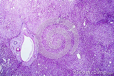 Cloudy Swelling Of The Liver, Light Micrograph Stock Photography ...