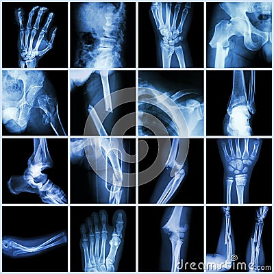 Collection X-ray Multiple Bone Fracture Royalty-Free Stock Photo ...