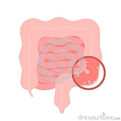 Colonoscopy Intestine, Polypectomy Procedure, Removal Polyp In Colon ...