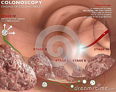 Colonoscopy And Probe Stock Illustration - Image: 41041914