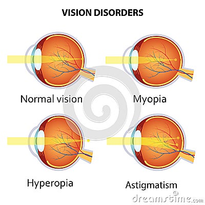 Common Vision Disorders. Stock Vector - Image: 78029425