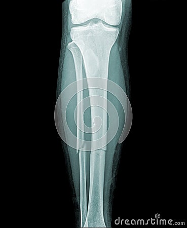 Complete Fracture Of The Lower Leg Royalty Free Stock Photos - Image ...