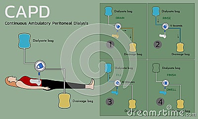 Continuous Ambulatory Peritoneal Dialysis (CAPD) Cartoon Vector ...