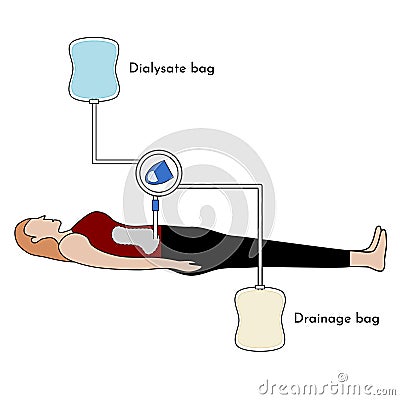 Continuous Ambulatory Peritoneal Dialysis (CAPD) Vector Illustration ...