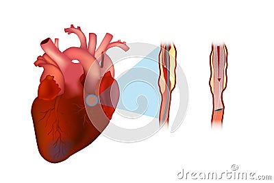 A Coronary Stent Is A Tube-shaped Device Placed In The Coronary ...