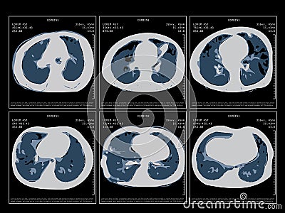 Covid-19 Computed Tomography Of The Lungs. CT Scan Cartoon Vector ...