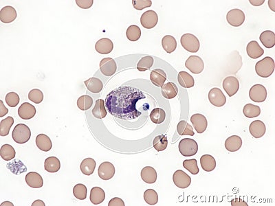 Cryptococcus In Peripheral Blood Smear. Royalty-Free Stock Image ...