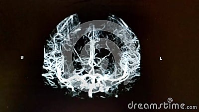 CT Brain Angiography - Rotating Frontal Image in Black, White Stock ...