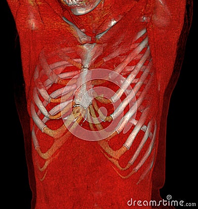 CT Chest 3d Rendering Realistic Chest Anatomically Correct Ribcage ...