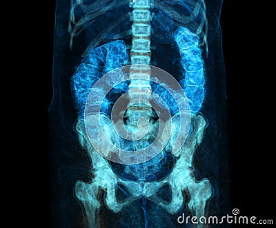 CT Colonography Or CT Scan Of Colon 3D Rendering Image For Screening ...