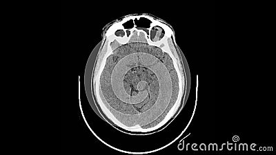 CT Scan. Computed Tomography. Skull Stock Footage - Video of hospital ...