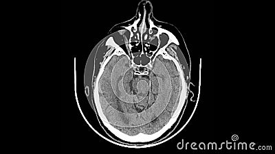 CT Scan. Computed Tomography. Skull Stock Video - Video of medicine ...