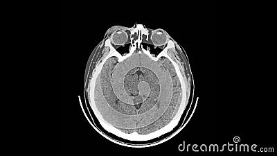 CT Scan. Computed Tomography. Skull Stock Footage - Video of pain ...