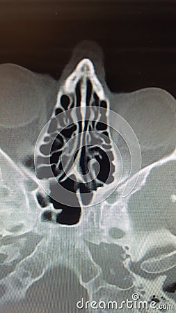 CT Scan Of The Ethmoid Sinus Air Cells Stock Photography ...