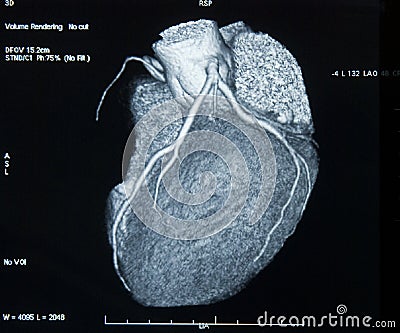 CT-Scan Heart Stock Photo - Image: 17951270
