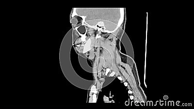 Ct Scan of Neck Side View Smooth Motion Stock Footage - Video of ...