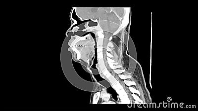Ct Scan of Neck Side View Smooth Motion Stock Footage - Video of ...